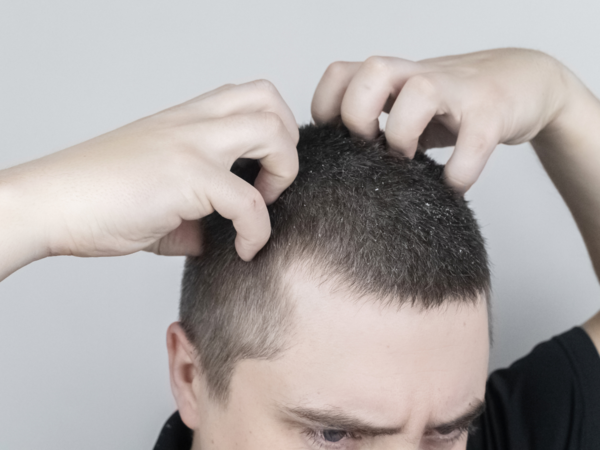 Itchy Scalp: How to soothe an itchy scalp during winter - Times of India