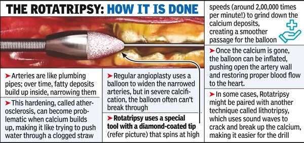 Rotatripsy: City Doctor Uses ‘rotatripsy’ To Save Patients With Severe ...