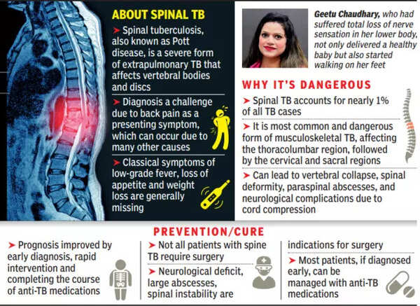 Spinal Tuberculosis: Woman with Spinal TB Walks After 7 Months ...