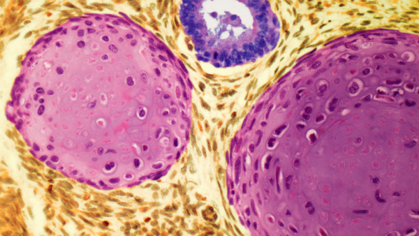 6 signs of testicular cancer every man should watch out for - Times of ...