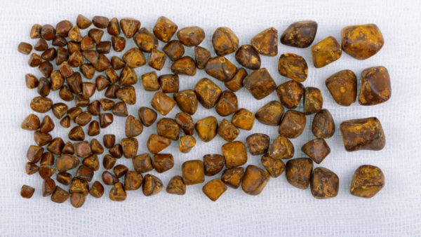 Gallbladder Stones 101: A comprehensive guide to cholelithiasis - Times ...