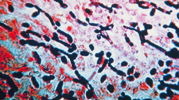 Esophageal Atresia: How to know if your child suffers from this ...