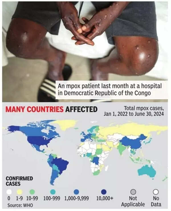 Why mpox has triggered second global alert in 2 years - Times of India