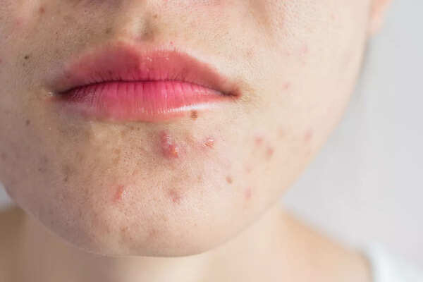 Myth or reality: Does eating junk food cause pimples? - Times of India