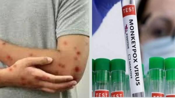 monkeypox in india: Explained: Why gay men are at higher risk to ...