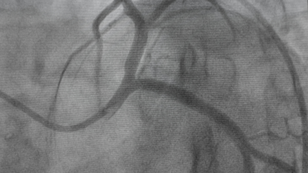 Do you need an Angiogram? Signs and symptoms that lead to this test ...