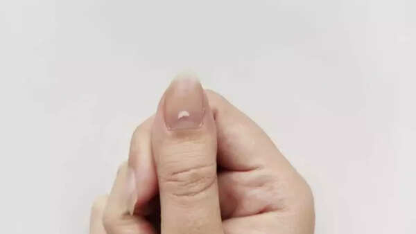 Unusual signs of high cholesterol in hands - Times of India