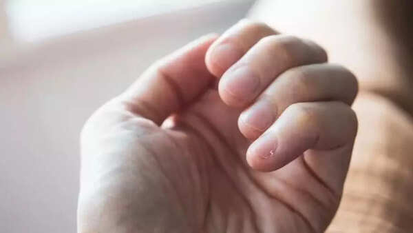 Unusual signs of high cholesterol in hands - Times of India
