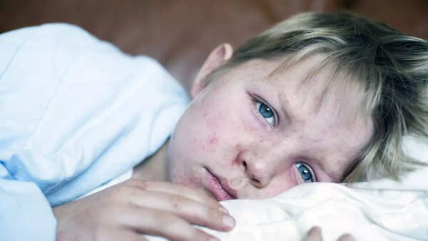 Measles on the rise in the US: Symptoms to not miss in adults | - The ...