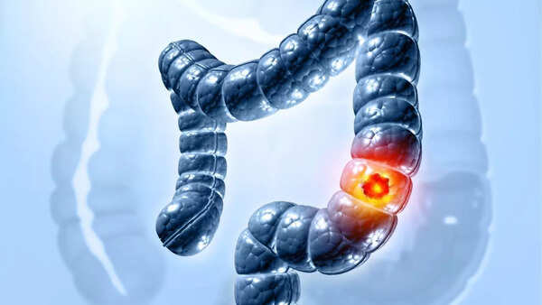 Early warning signs of colon cancer: How to reduce your risk | - The Times of India