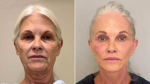 9 cosmetic procedures in 6 hours! Here's the jaw-dropping ...