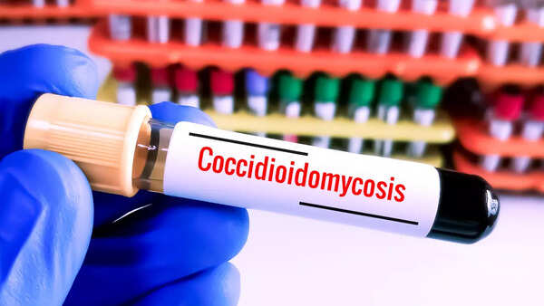 Valley fever turning into an endemic in California: Scientists find a ...