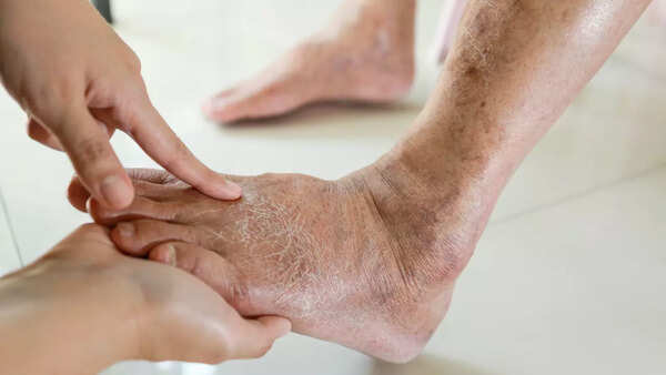 5 health warning signs in the feet you should not dismiss | - Times of ...