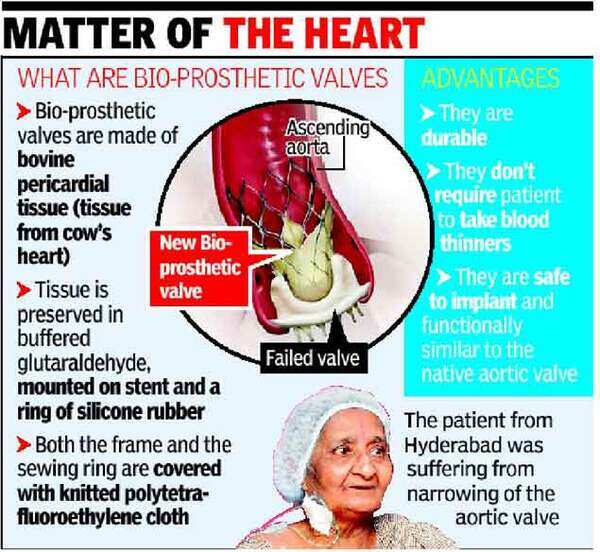 Valve from cow’s heart gives new lease of life to 81-year-old woman ...