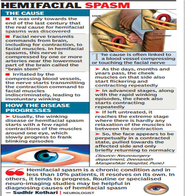 ‘Winking disease’ can be cured, say experts | Pune News - Times of India