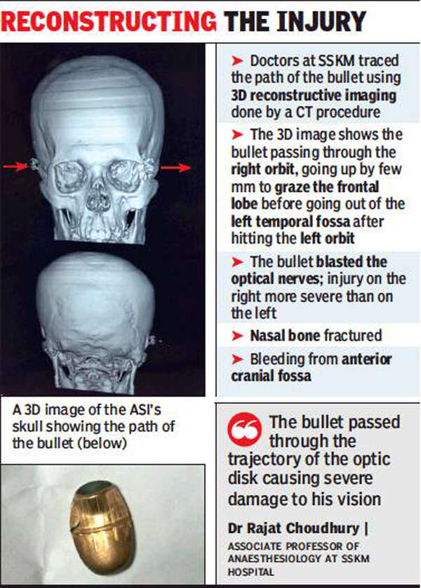 ASI shooting: Doctors use 3D image to trace bullet’s path | Kolkata ...