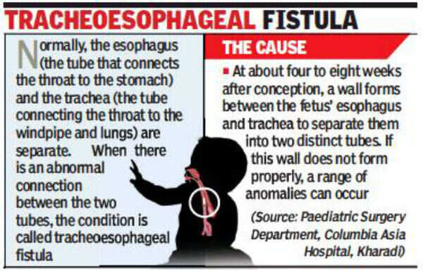 Doctors save baby born with multiple birth defects | Pune News - Times ...