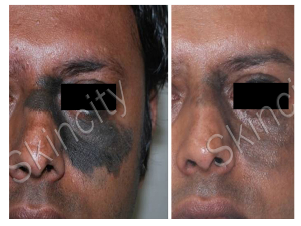 A Revolutionary Technology to Remove Birthmarks - Times of India