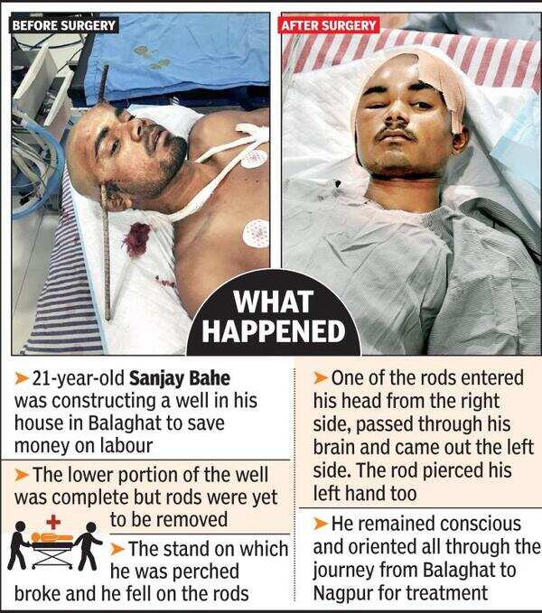 Iron rod pierces brain; Maharashtra man, 21, lives to tell tale ...