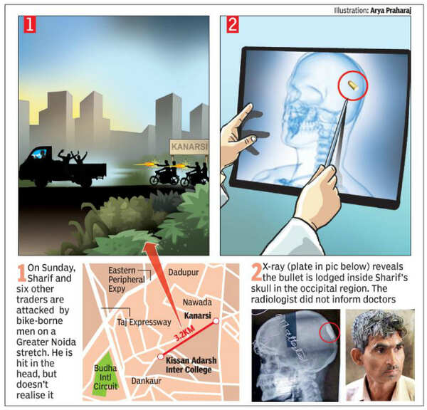 Headache for 6 days: It was a bullet in skull | Noida News - Times of India