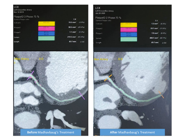 For Heart Blockages, More People Are Opting For Non-invasive Ayurveda ...