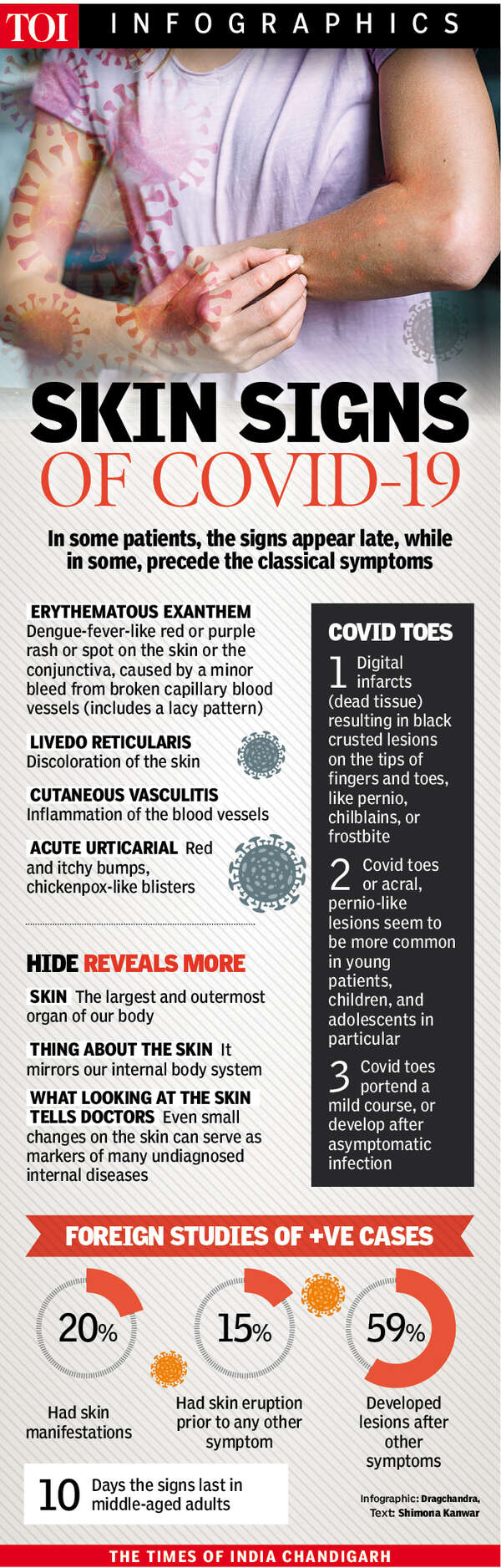 New way of detecting corona: By the skin | Chandigarh News - Times of India