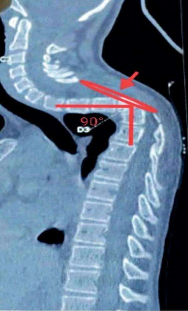 95° cervical hunch corrected at Civil | Ahmedabad News - Times of India
