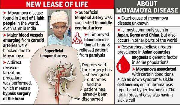 Complicated Surgery Saves Girl With Rare Moyamoya Disease | - Times of ...