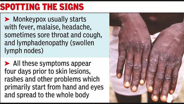 Monkeypox: Kerala confirms that deceased youth tested +ve for monkeypox ...