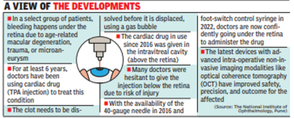 New devices prove visionary to treat retinal bleed patients: Eye ...