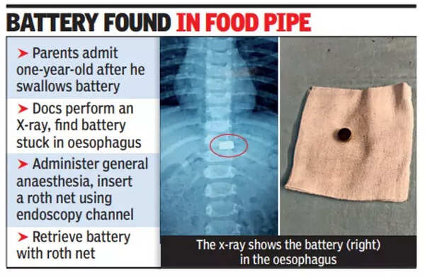 Noida: Toddler swallows battery while playing with toy, an emergency ...
