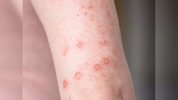 STI symptoms: THESE changes in hair and mouth could signal syphilis ...