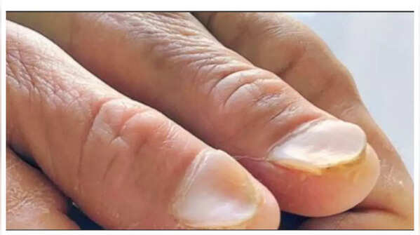 Iron Deficiency Symptoms: Not just tiredness: 5 unusual signs of Iron ...