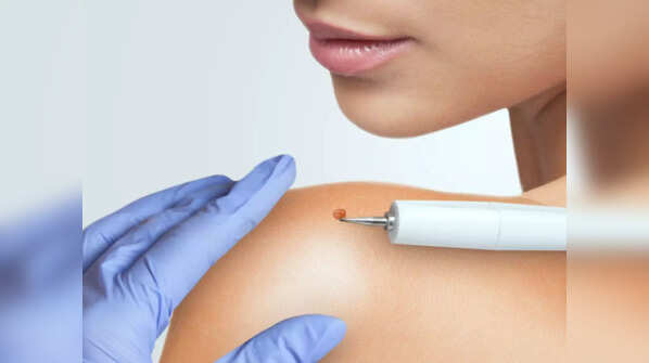 Moles on Body Parts: What moles on different body parts reveal about your personality