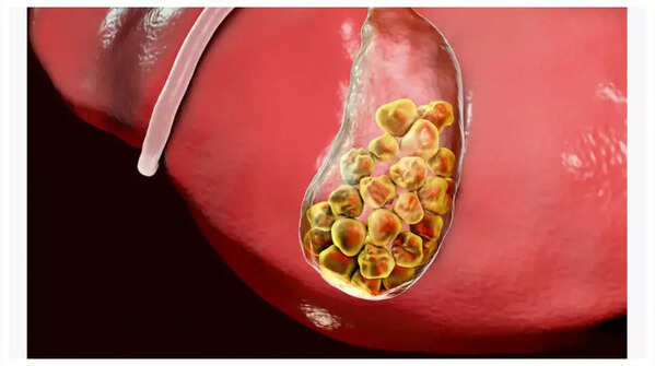 Why do stones get formed in the kidney and gallbladder: 4 things to do ...