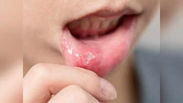 Does Vitamin B12 Help With Mouth Sores - Infoupdate.org