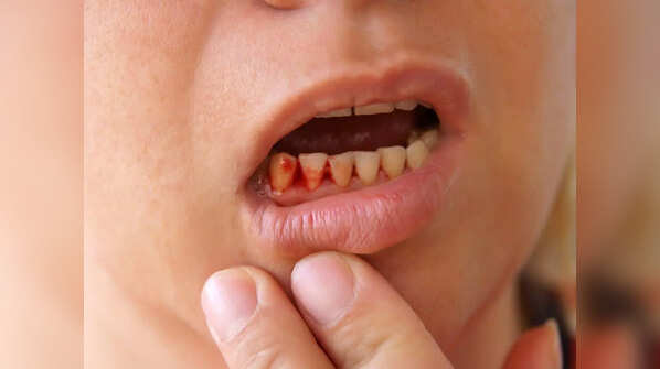 Vitamin Deficiency Symptoms: 5 signs of Vitamin Deficiency on your face