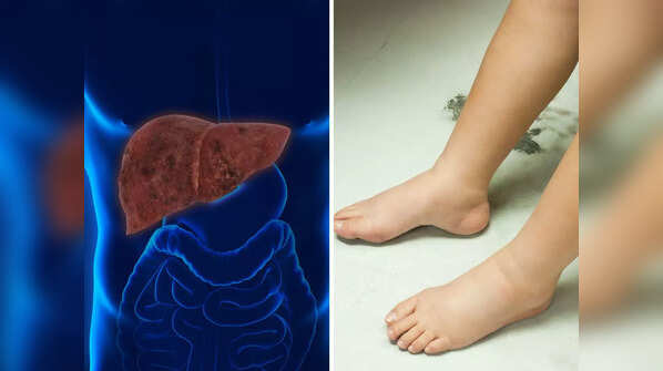 Fatty liver disease: Two warning signs in your leg and abdomen
