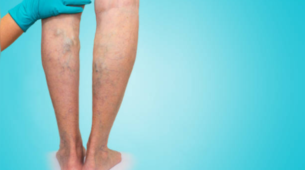 Chronic Venous Insufficiency Symptoms: 9 reasons why it happens and how to identify it early
