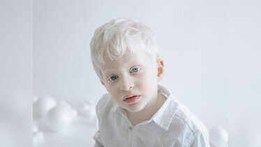 Beautiful People With Albinism