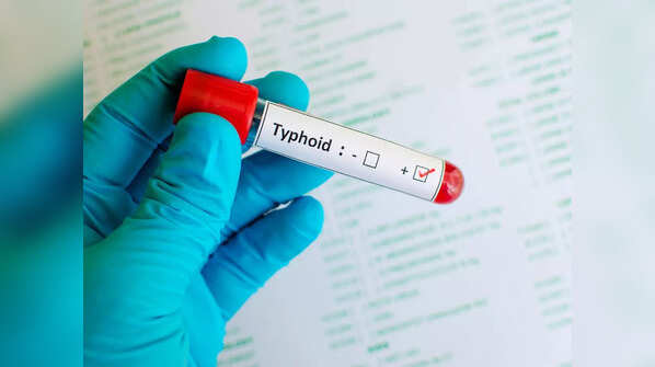 Typhoid Symptoms: 5 ways the infection can spread; tell-tale symptoms ...