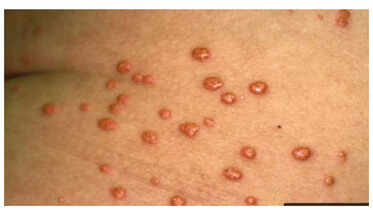 Heart Failure Skin