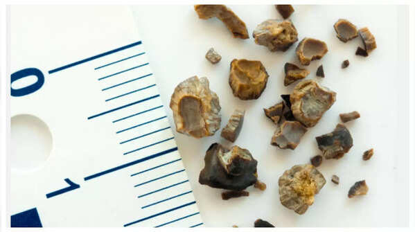 Uric Acid Stones Symptoms: What are uric acid stones: 3 major reasons ...