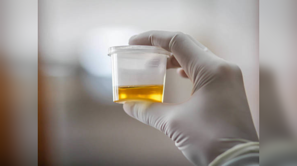 Yellow Urine Symptoms: Why is urine yellow? Unraveling the science ...