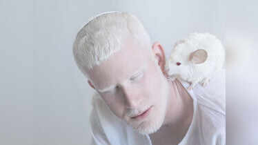 Gujarati People Albino Albinism India Group