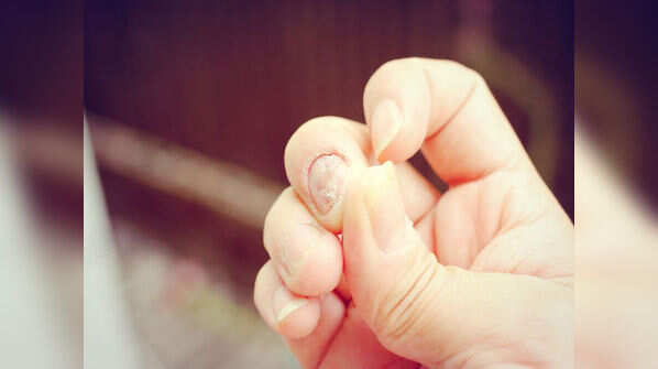 Why you should never rip off your hangnail