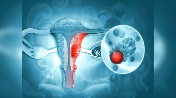 Gynaecological Cancers Symptoms: THESE common symptoms could signal 5 ...