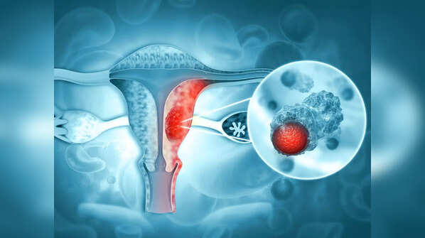 Vulvar Cancer Symptoms: Signs of vulvar cancer that may be misdiagnosed ...