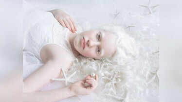 Gujarati People Albino Albinism India Group