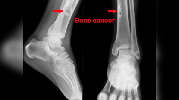 Bone Cancer Signs: How does bone cancer start? Here are some warning ...